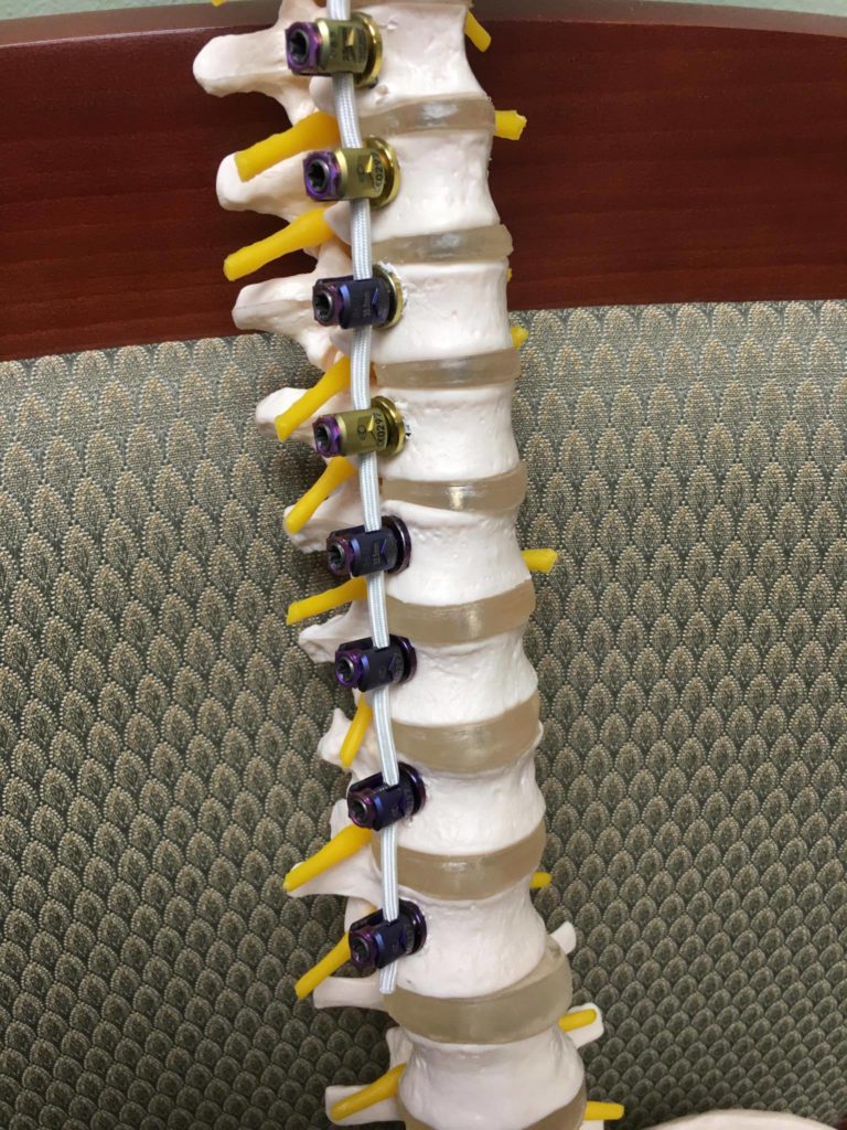 Vertebral Body Tethering – VBT | Vertebral Body Tethering